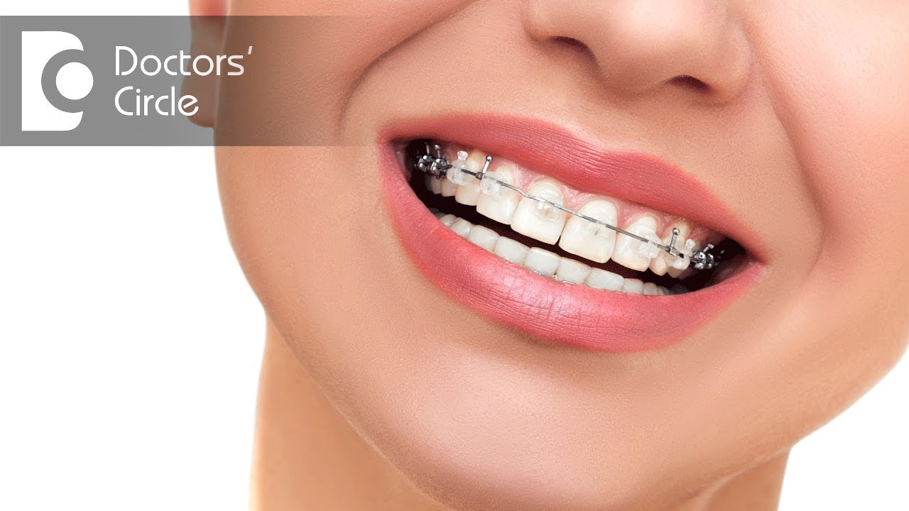 When Is Fixed Orthodontic Treatment Indicated Dr Divyashree when-is-fixed-orthodontic-treatment-indicated-dr-divyashree