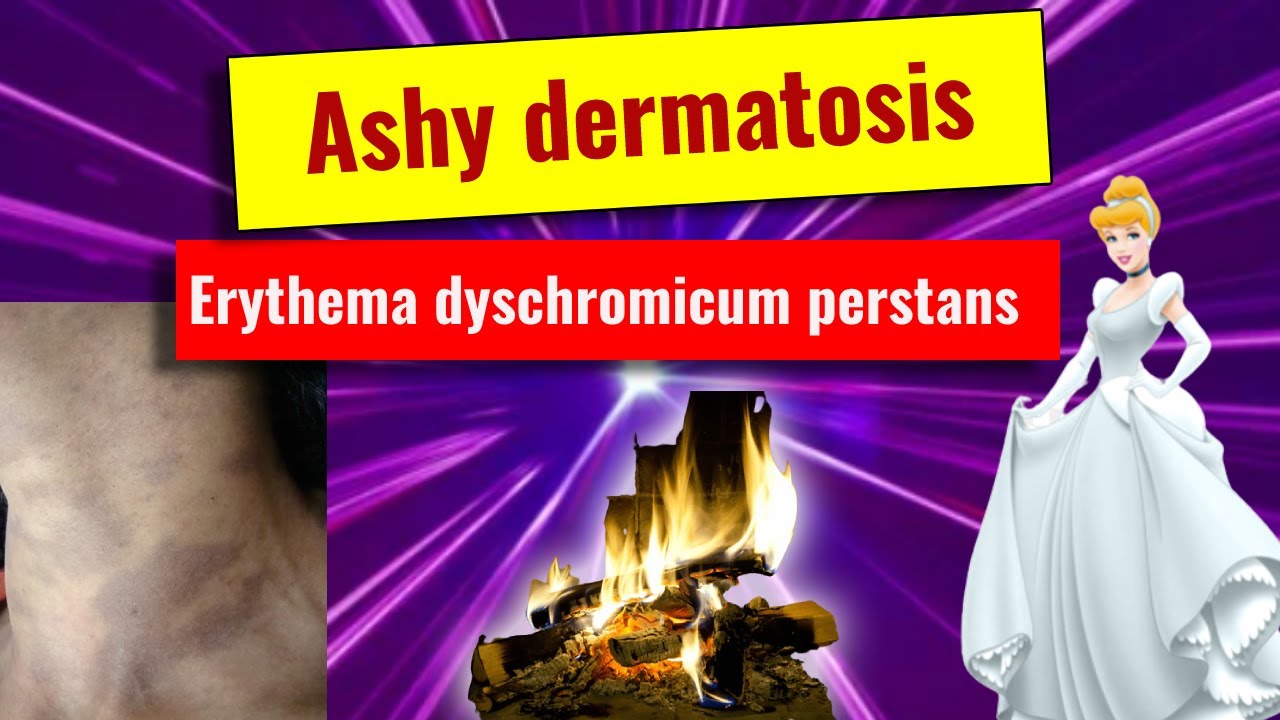Ashy dermatoses, Erythema dyschromicum perstans: overview, features ...