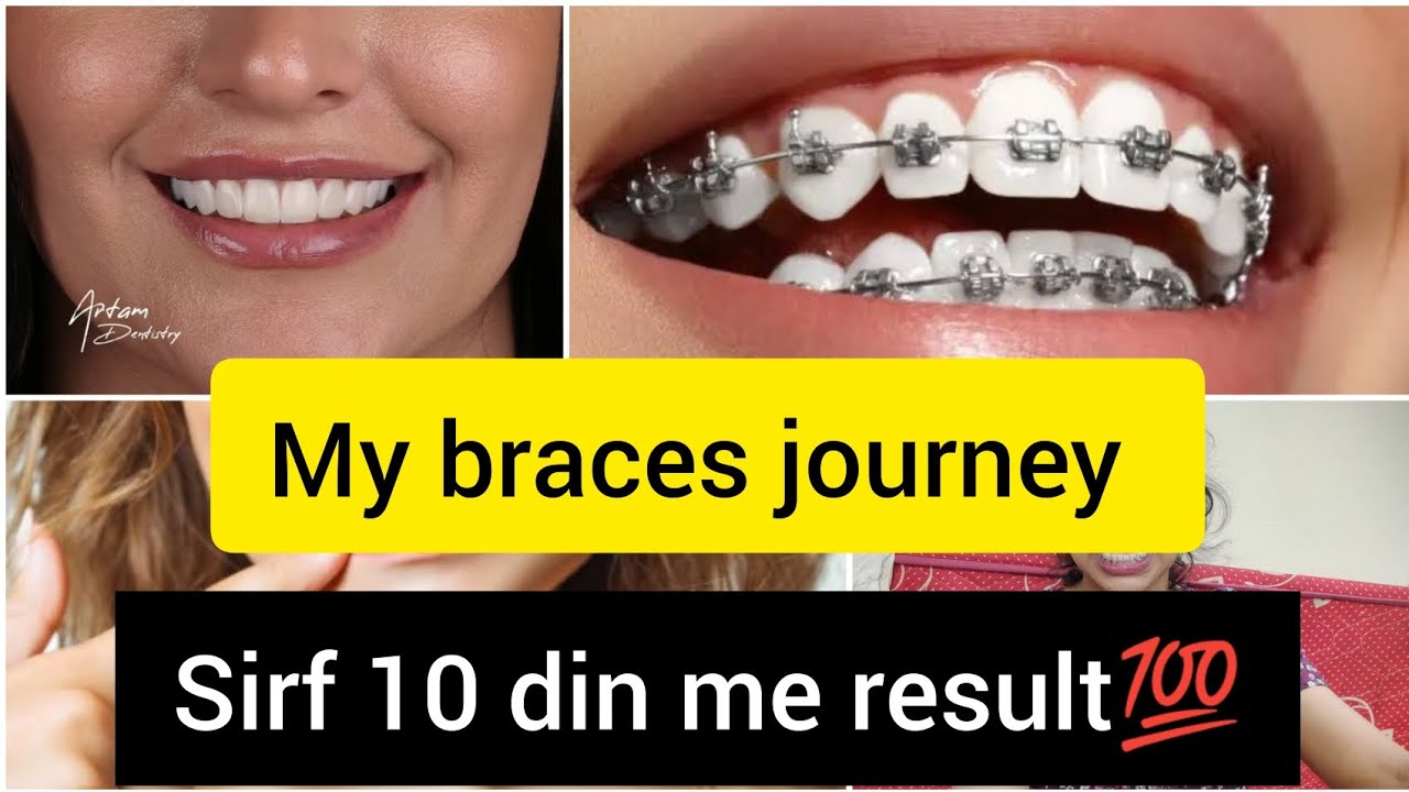 braces vlog || getting braces on vlog #bracesjourney #bracesupdate ...