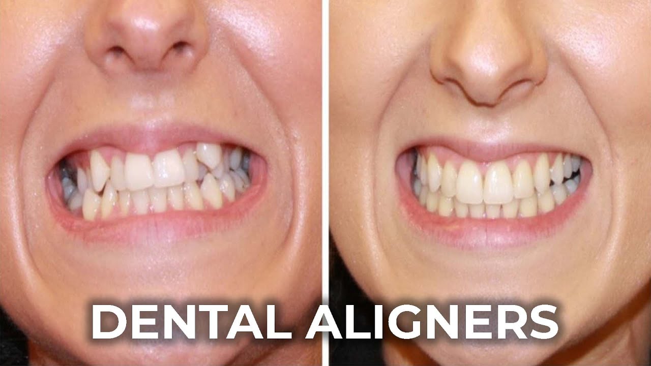 Transform Your Smile with Clear Dental Aligners | Straighten Teeth ...