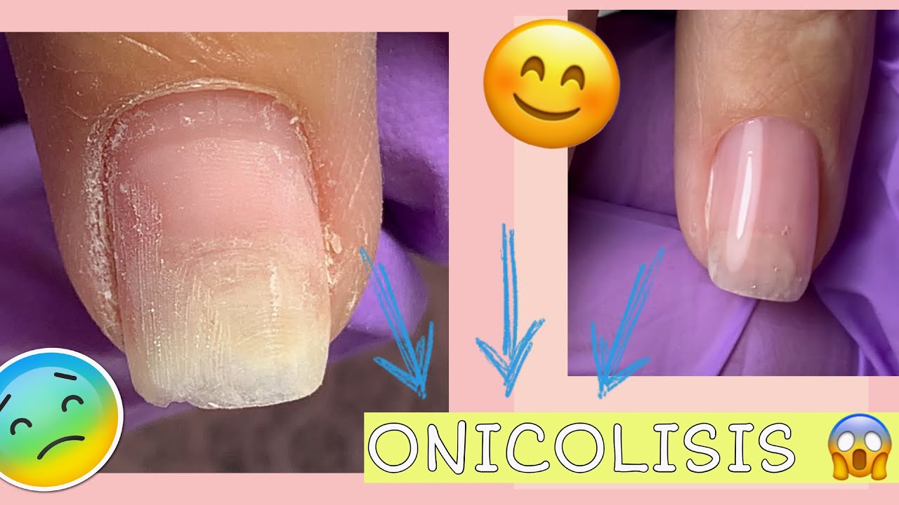 😱Uñas con ONICOLISIS‼️ 😱 | semipermanente | manicura - YouTube