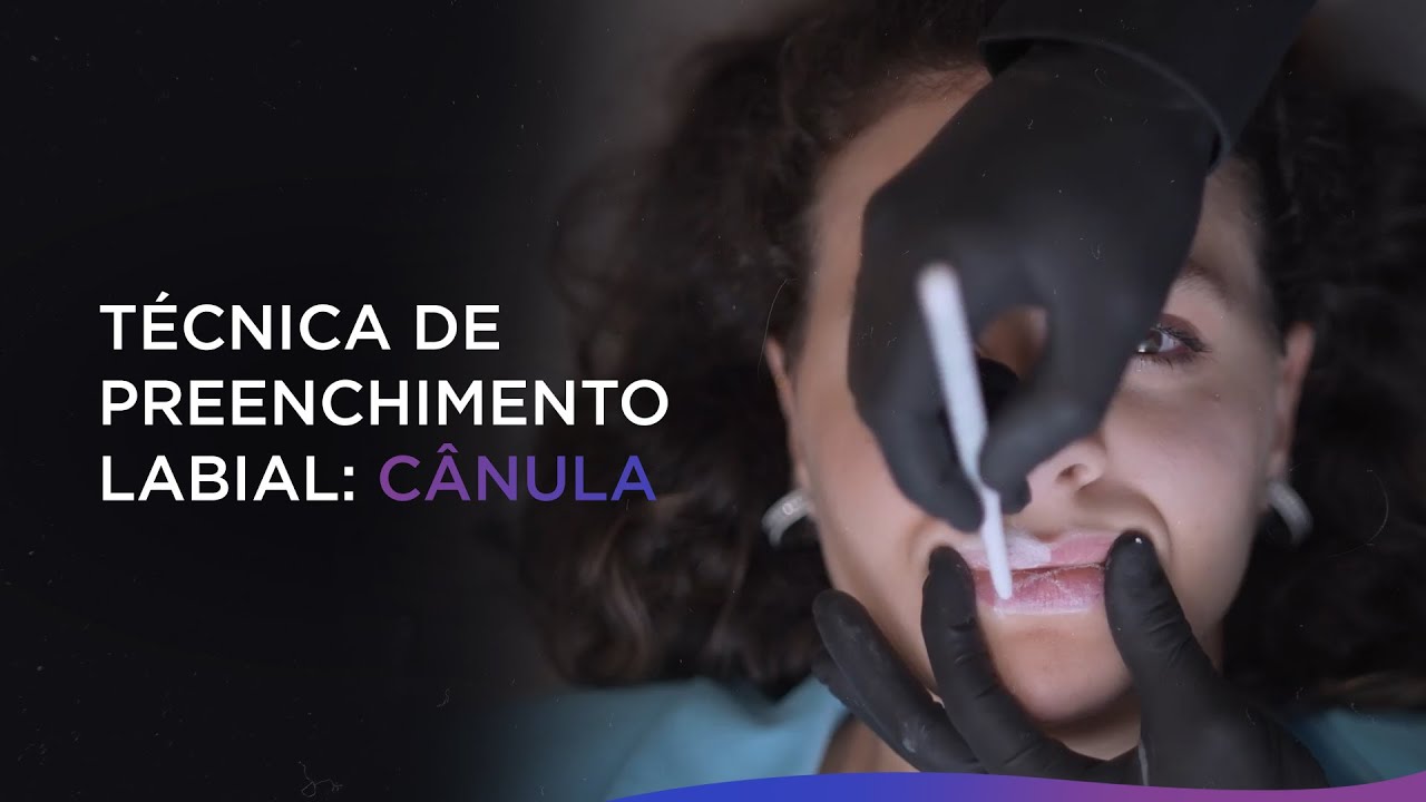 Preenchimento labial: Técnica com cânula - YouTube