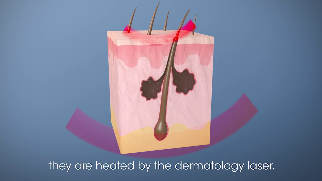 How the Sebacia Treatment Works - YouTube