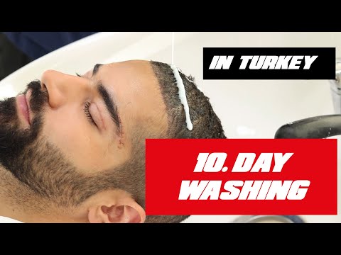 DHI Hair Transplant 10. Day Washing | Sercan Aslan Hair Clinic.