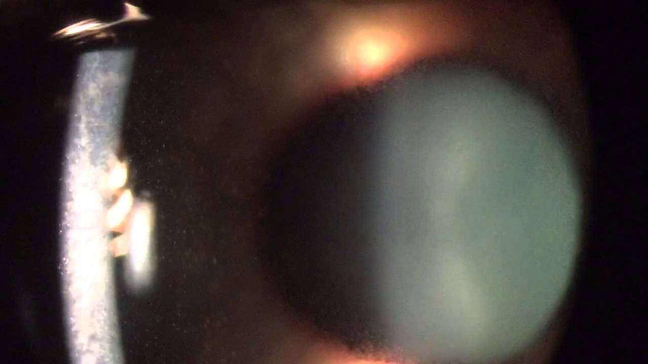 Anterior Chamber Cells And Flare YouTube Anterior Chamber Cells And Flare YouTube