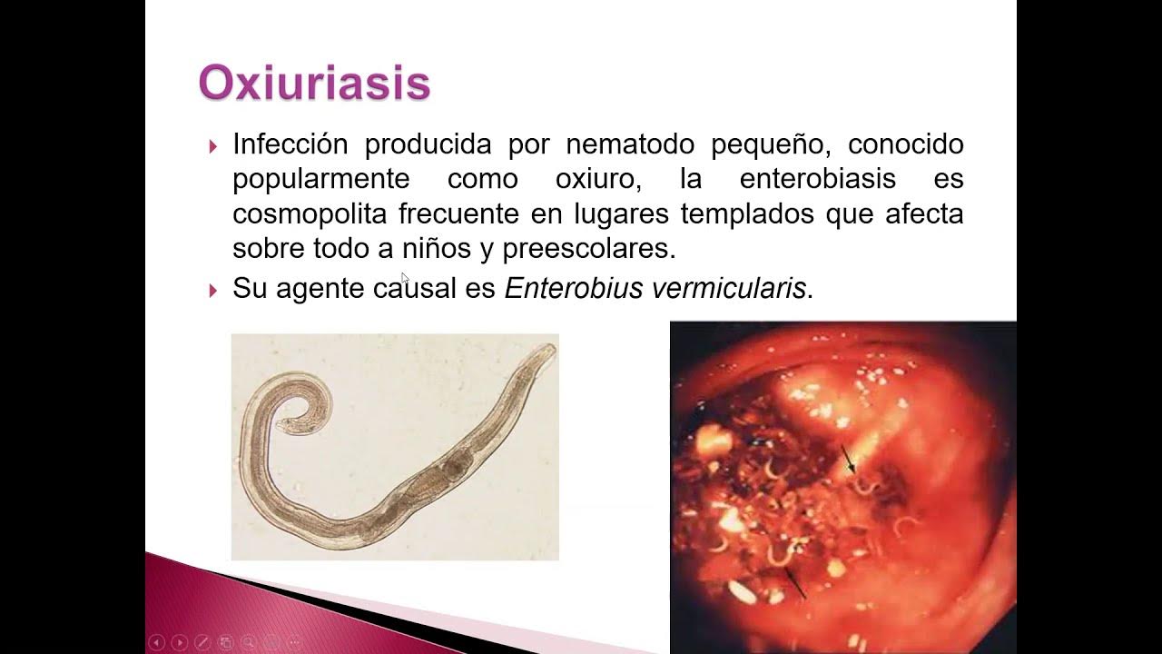 Enterobiasis u oxiuriasis - YouTube