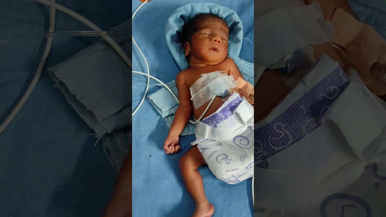 (premature Newborn baby 7 month delivery time) समय से पहले नवजात शिशु 7 ...