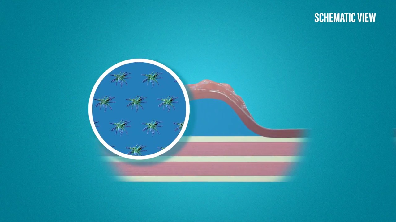 Eleview™ procedure demonstration - YouTube