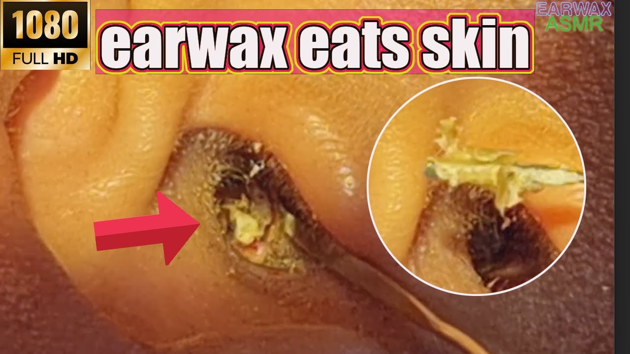 Earwax eats into the skin of the ear. Still, he decided to take it out ...