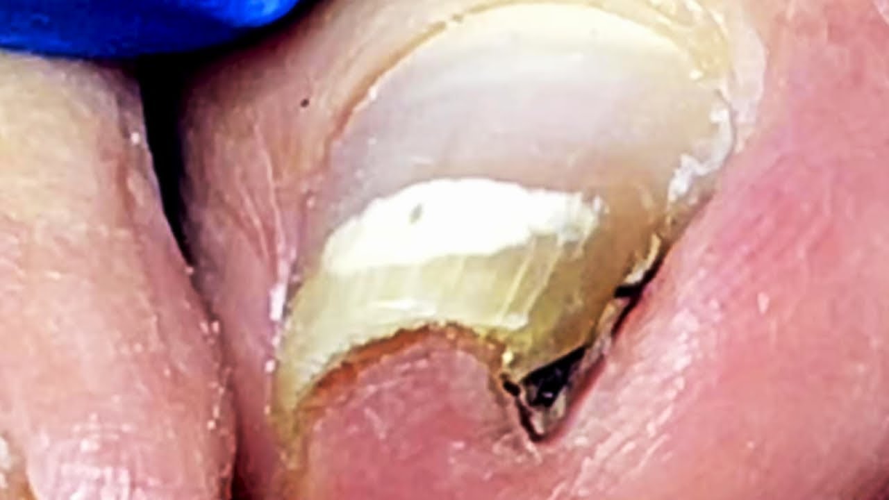 An Ingrown Toenail Is Curling Up And Digging Into Your Toe Remove It ...