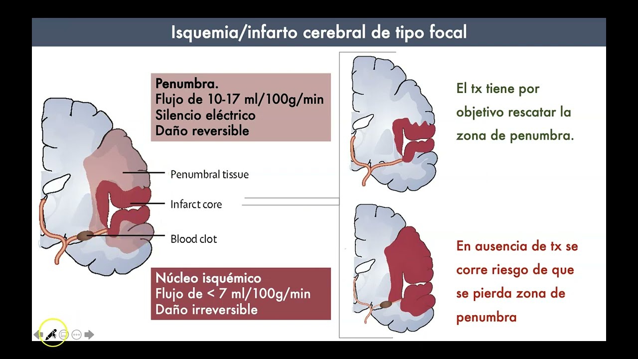 Enfermedad vascular cerebral. Parte 1. - YouTube