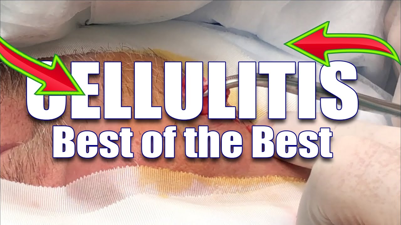 Boomer Arm Cyst Cellulitis - YouTube
