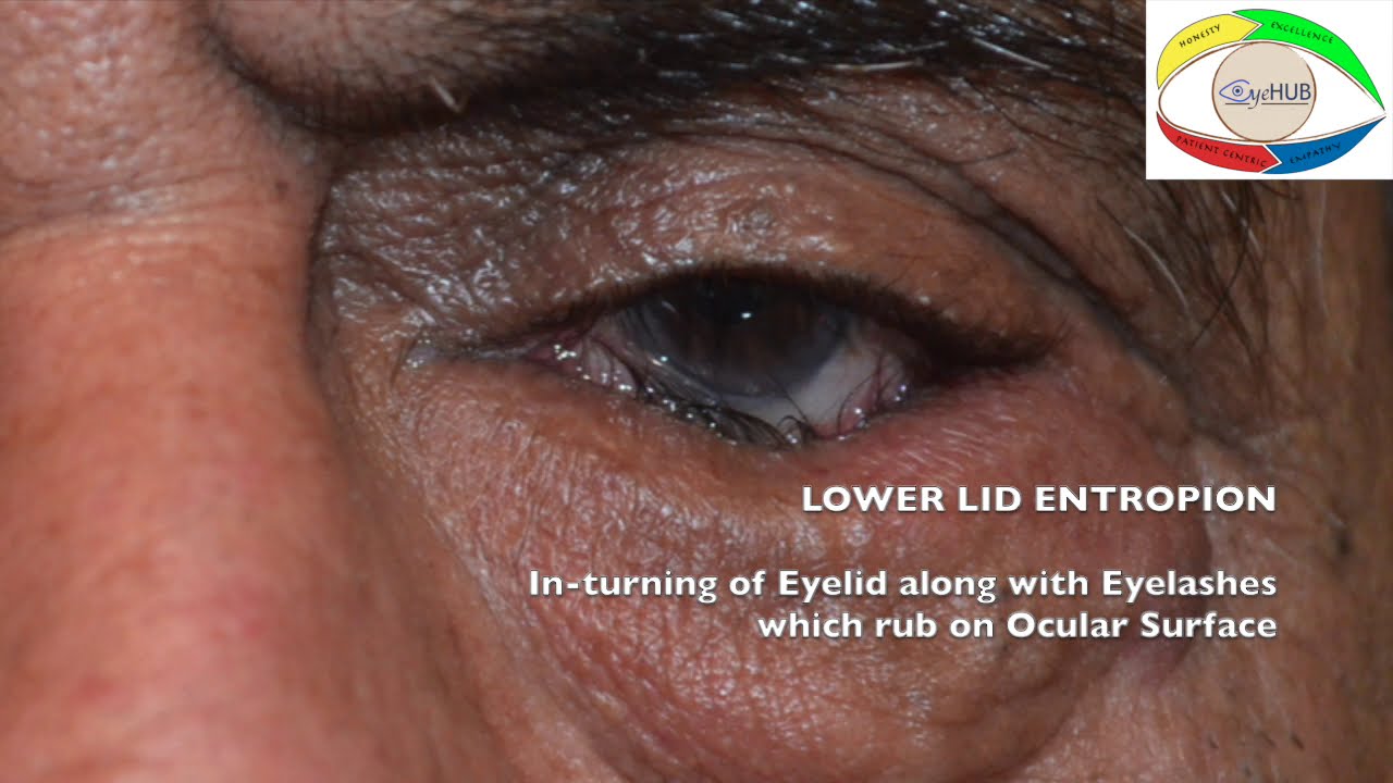 Eyelash Problem, Hair In-turning, Eyelid Entropion Surgery- Treatment ...