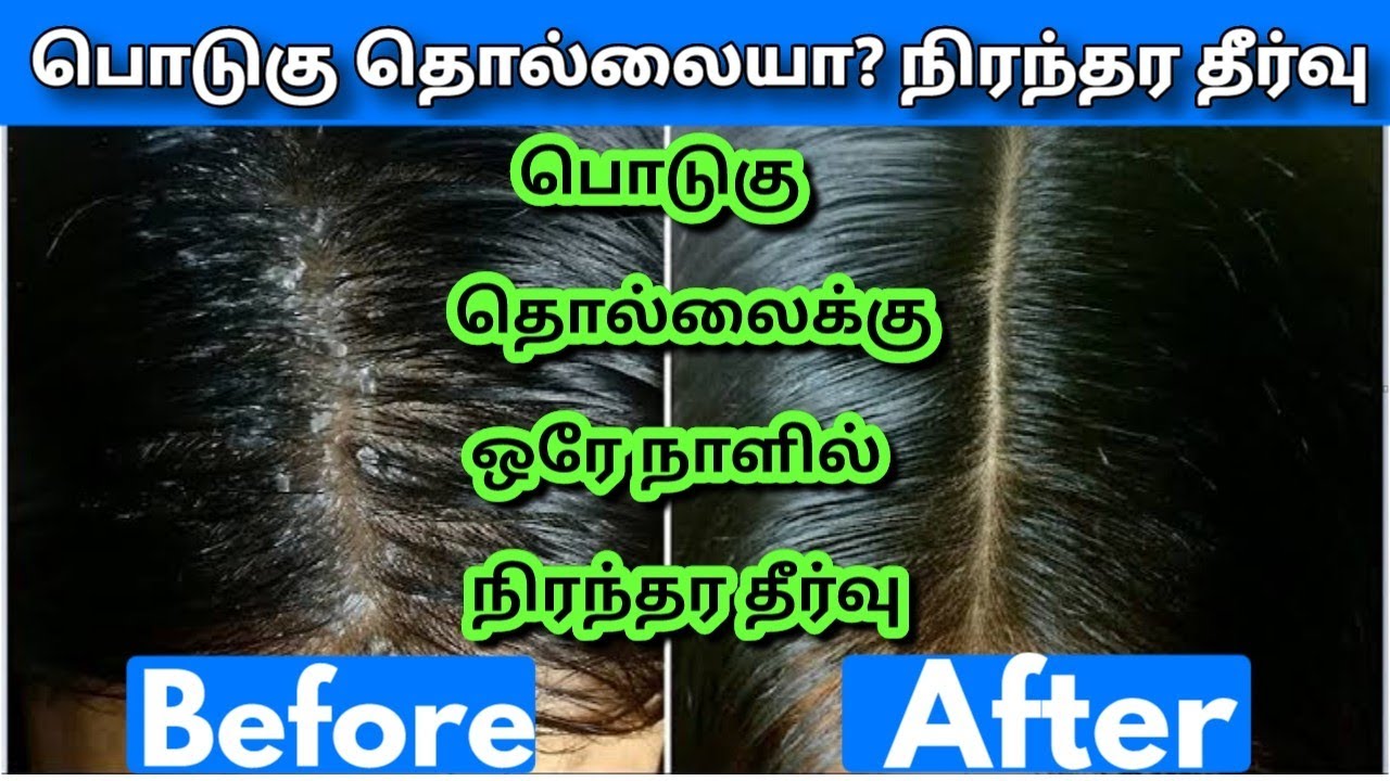 பொடுகு அடியோடு நீங்கி நன்கு முடி நீண்டு வளர | podugu poga tips in tamil ...