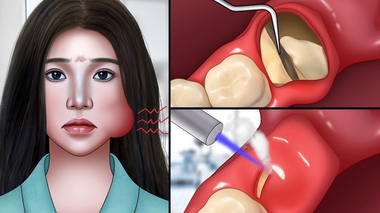 ASMR Impacted wisdom tooth extraction removal | Dental care animation - YouTube