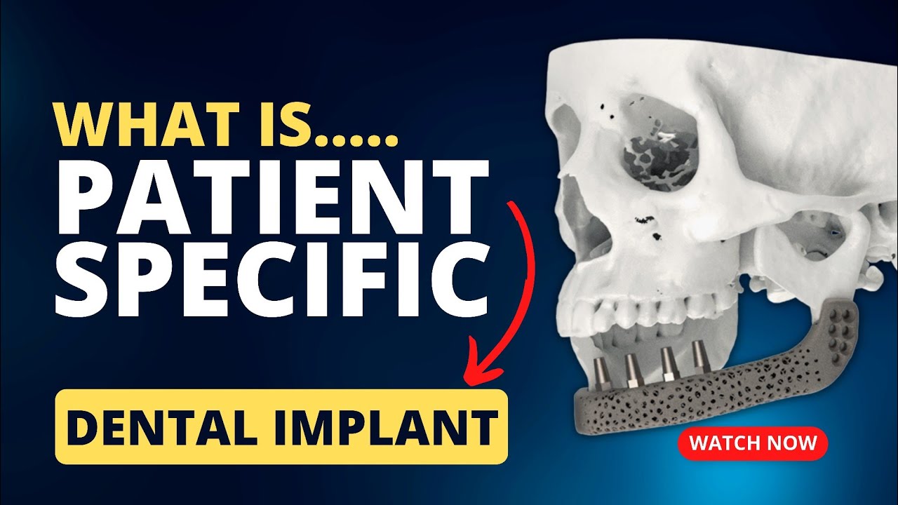 Patient-Specific dental Implants - YouTube