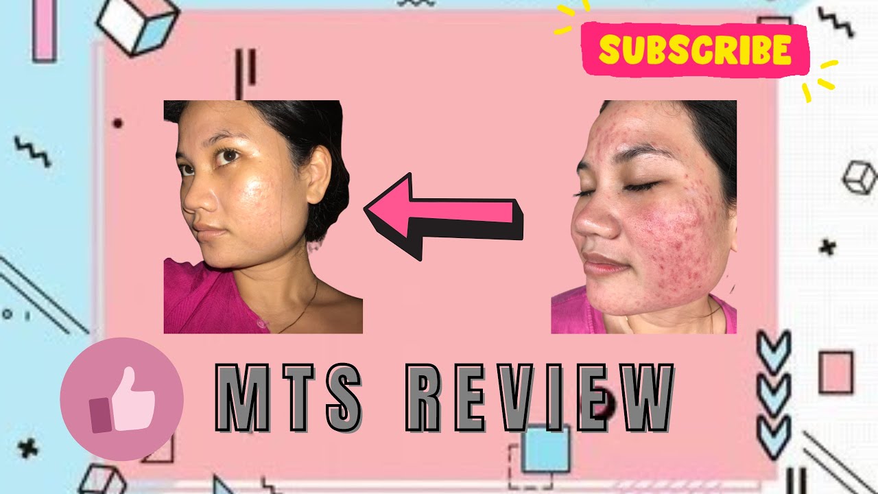REVIEW MTS TREATMENT - YouTube