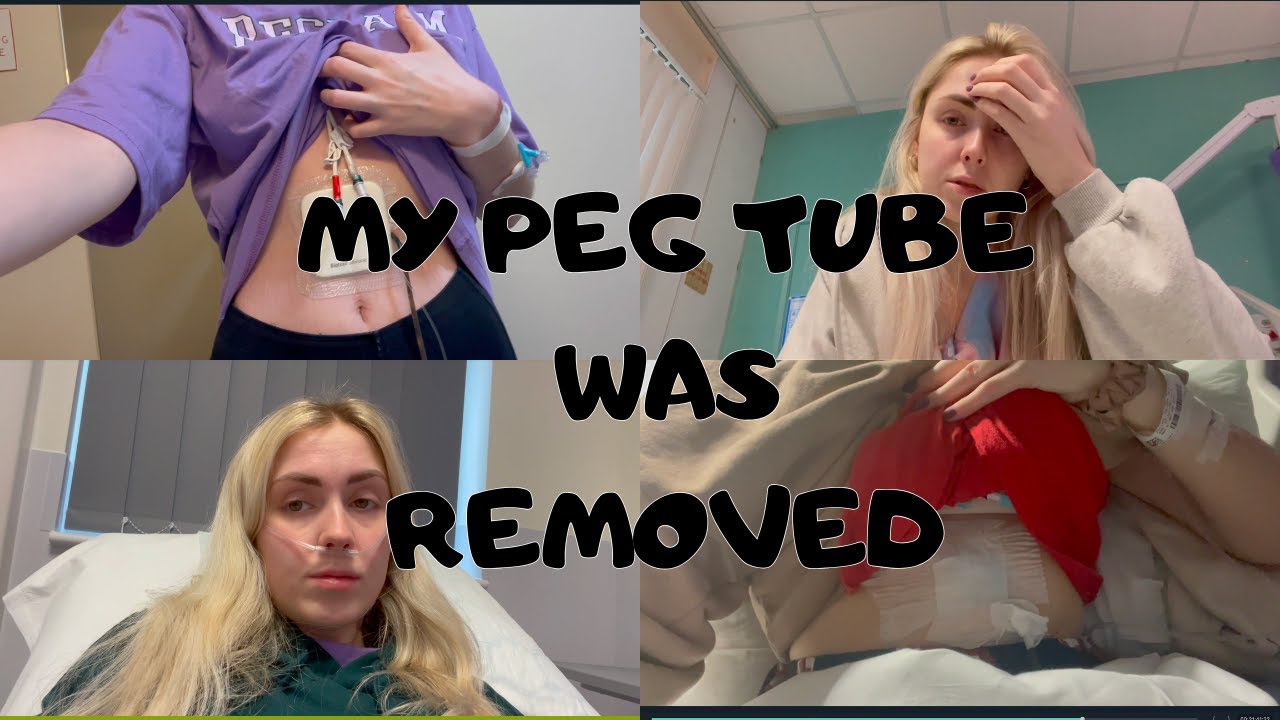 I had to have emergency surgery | Buried Bumper syndrome | PEG feeding ...