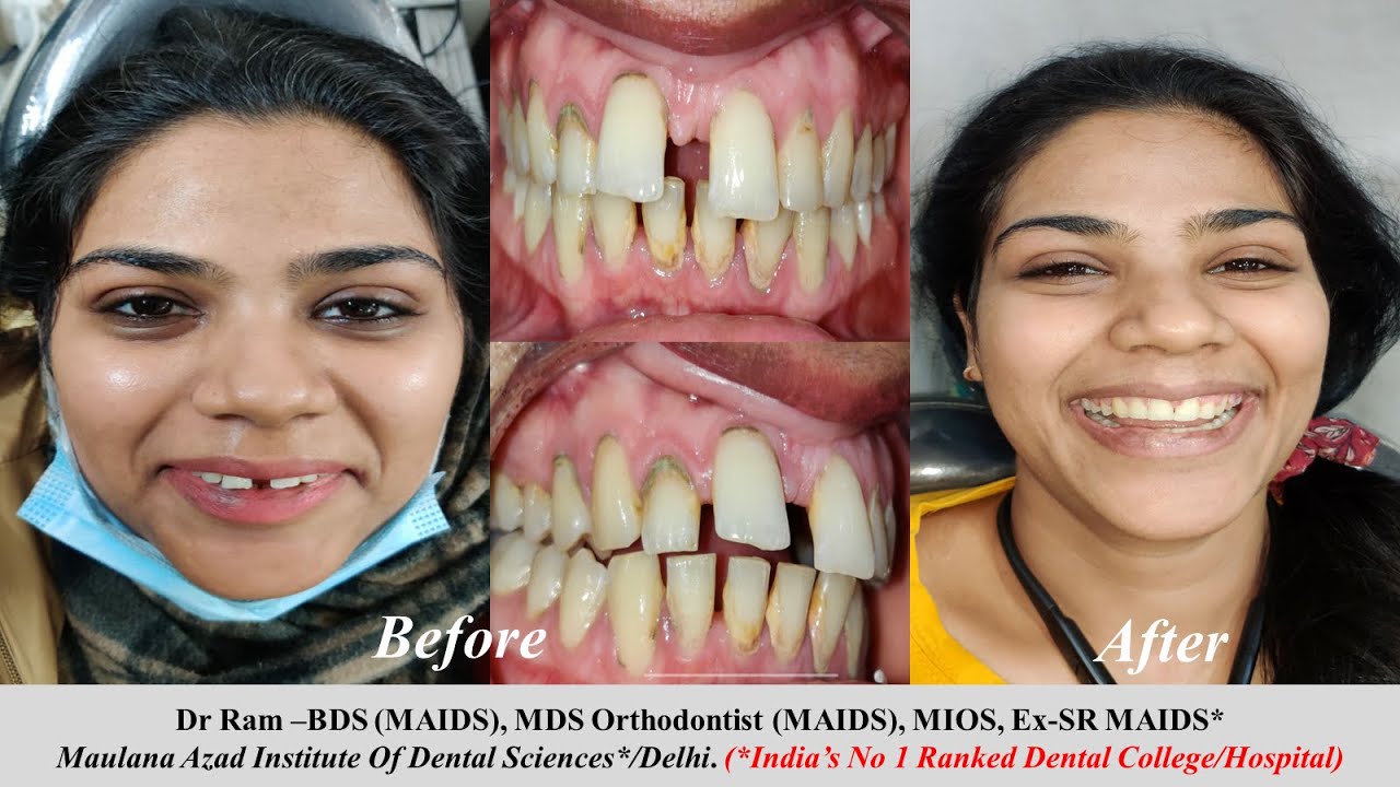 Huge Gap in Front Teeth - Correction By Braces I Smile Improvement I ...