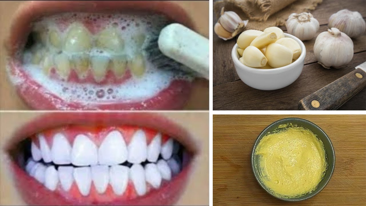 Teeth Whitening Recipe !! Mix Garlic With Toothpaste And You Will Thank ...