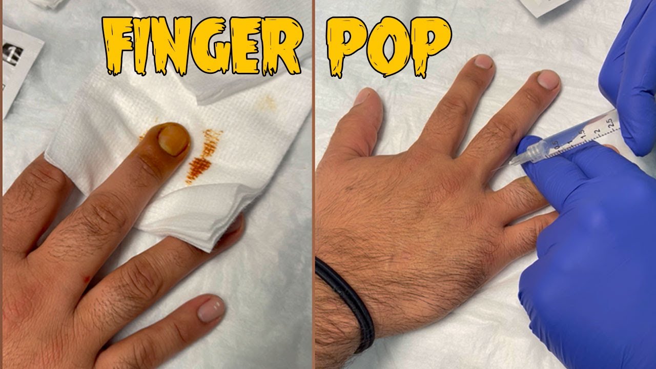 Fixing a Finger - Paronychia Pop - YouTube