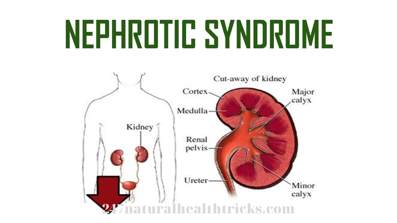 nephrotic-syndrome-cause-of-nephrotic-syndrome-is-nephrotic