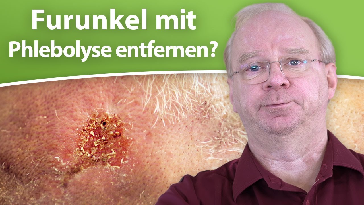 Furunkel mit der Phlebolyse behandelt - Dr. med. Agnes Reese klärt auf ...
