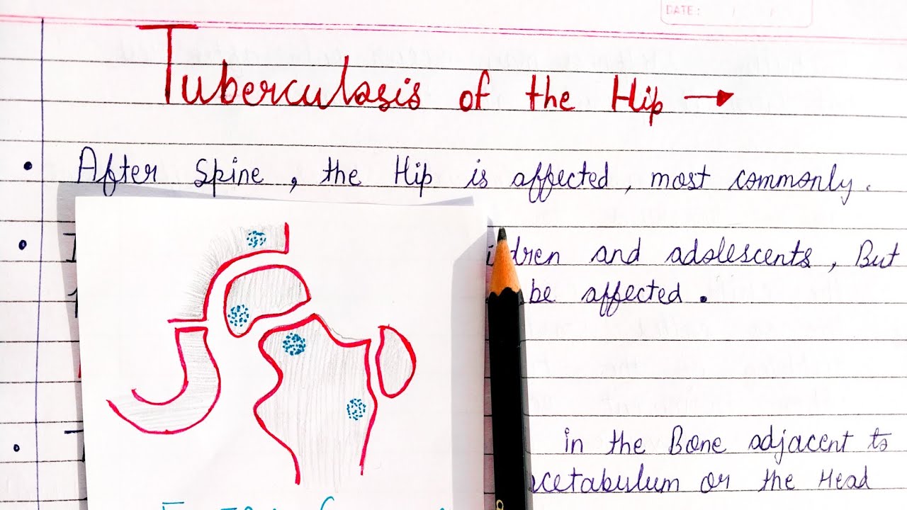 Tuberculosis of Hip - pathology, stages, clinical features, examination ...