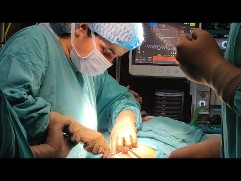 Complicated Appendicitis. Appendicular Perforation & Right Paranephric ...