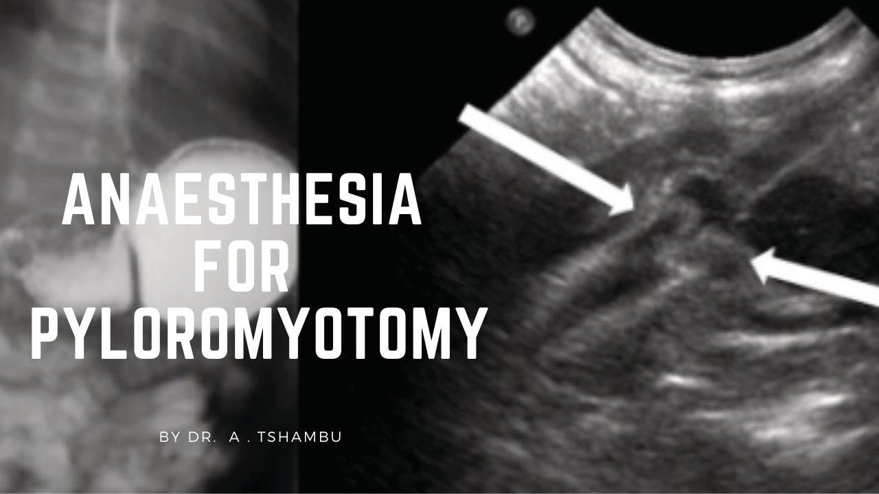 Anaesthesia for pyloromyotomy - YouTube