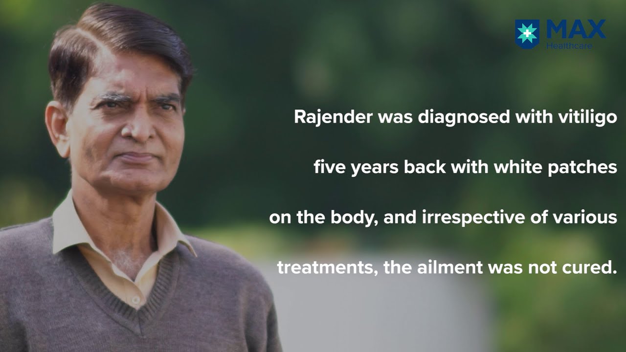 Narrowband UVB Light Therapy for Vitiligo │Patient Success Story │ Max ...