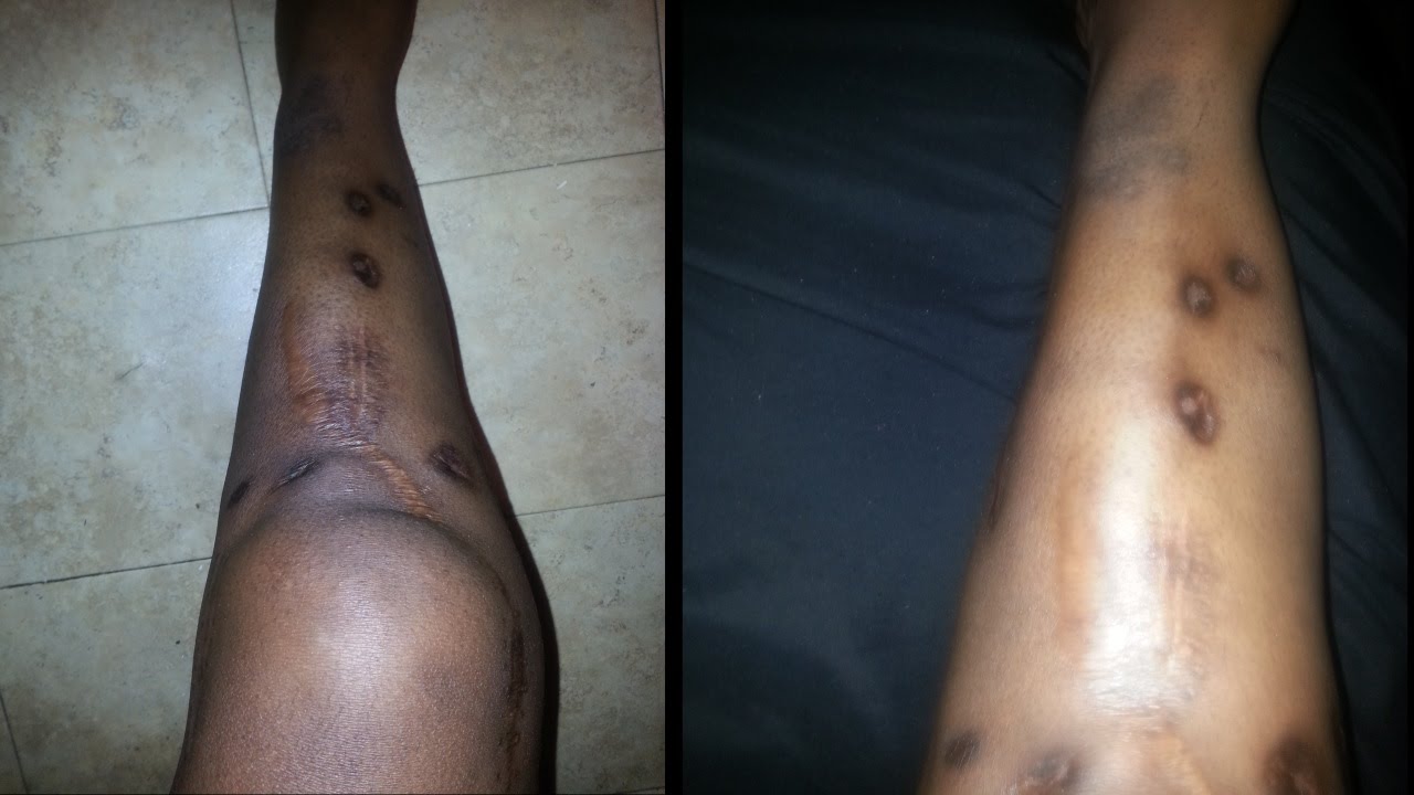 UPDATE | Fading Surgery Scars | 18% TCA Peel | Jessibaby901 - YouTube