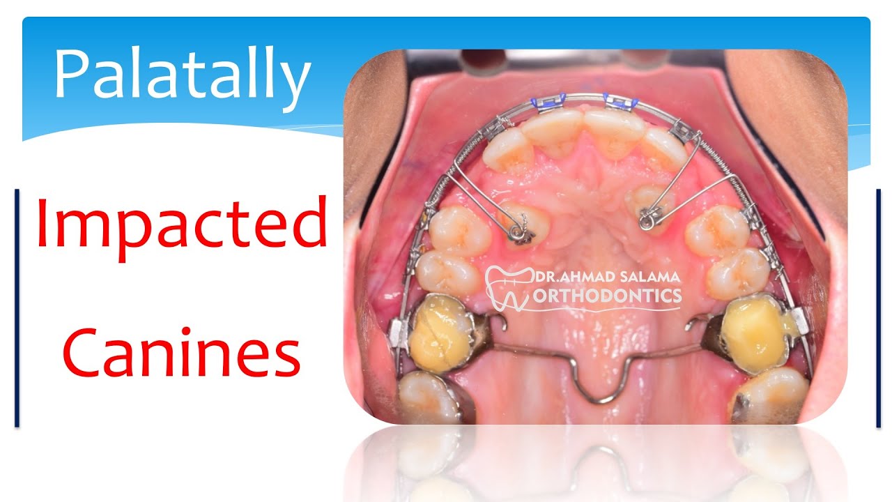 ep 23 | Bilateral palatal Impacted canines | Full case managment - YouTube