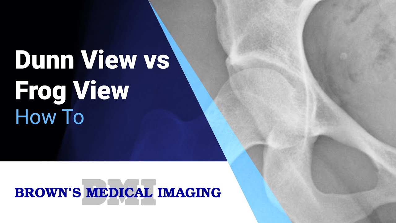 How to - Dunn View vs Frog View - YouTube