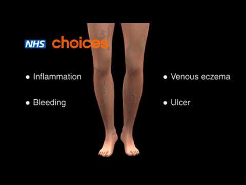 Varicose Veins Animation - THE VEIN CLINIC PERTH - YouTube
