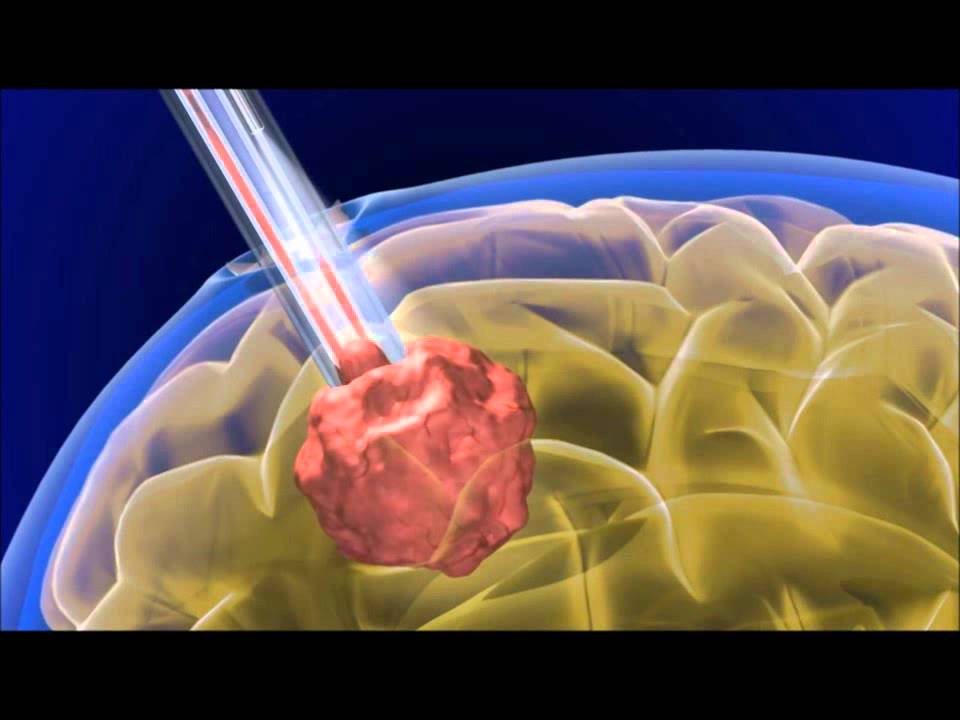 Neurology Surgery - YouTube