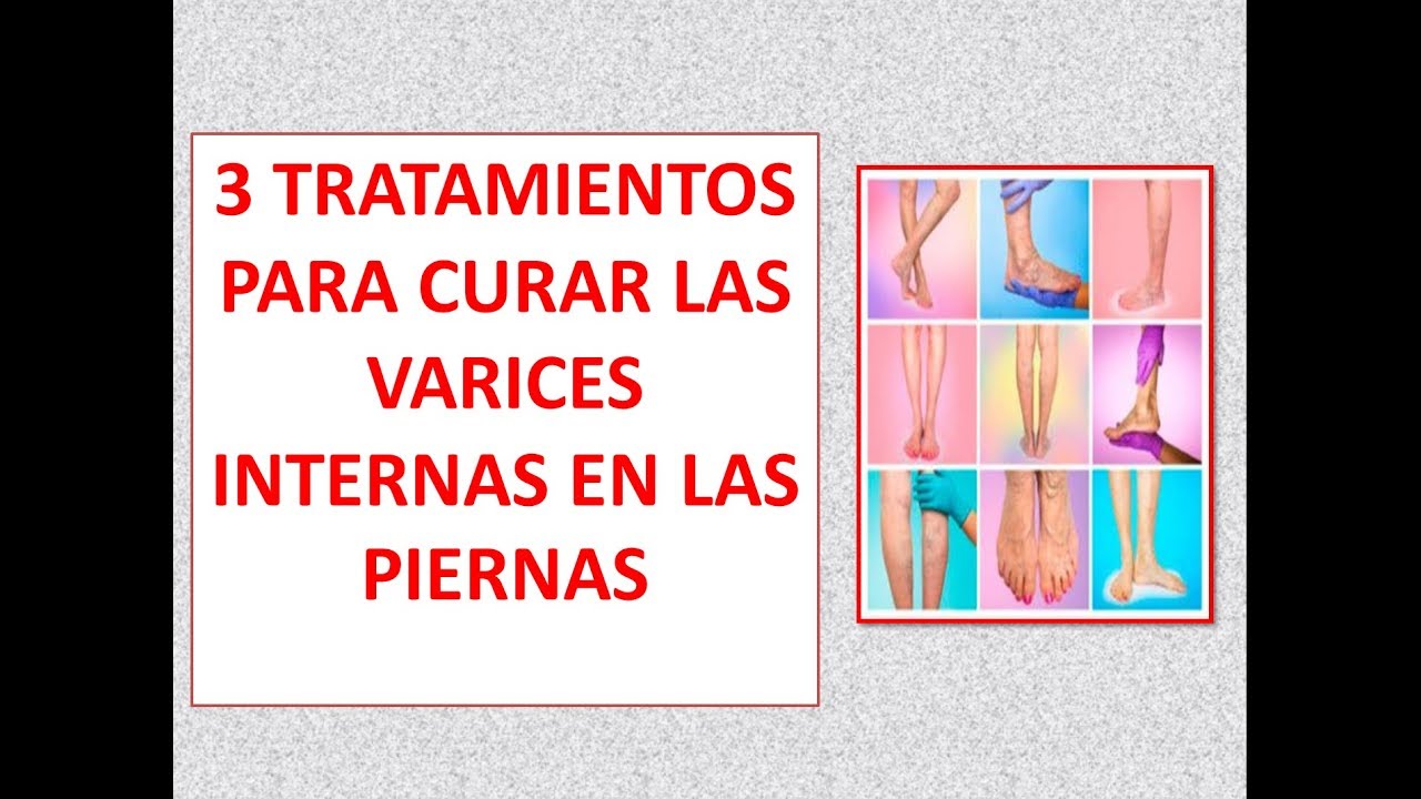 3 tratamientos para como curar las varices internas en las piernas ...