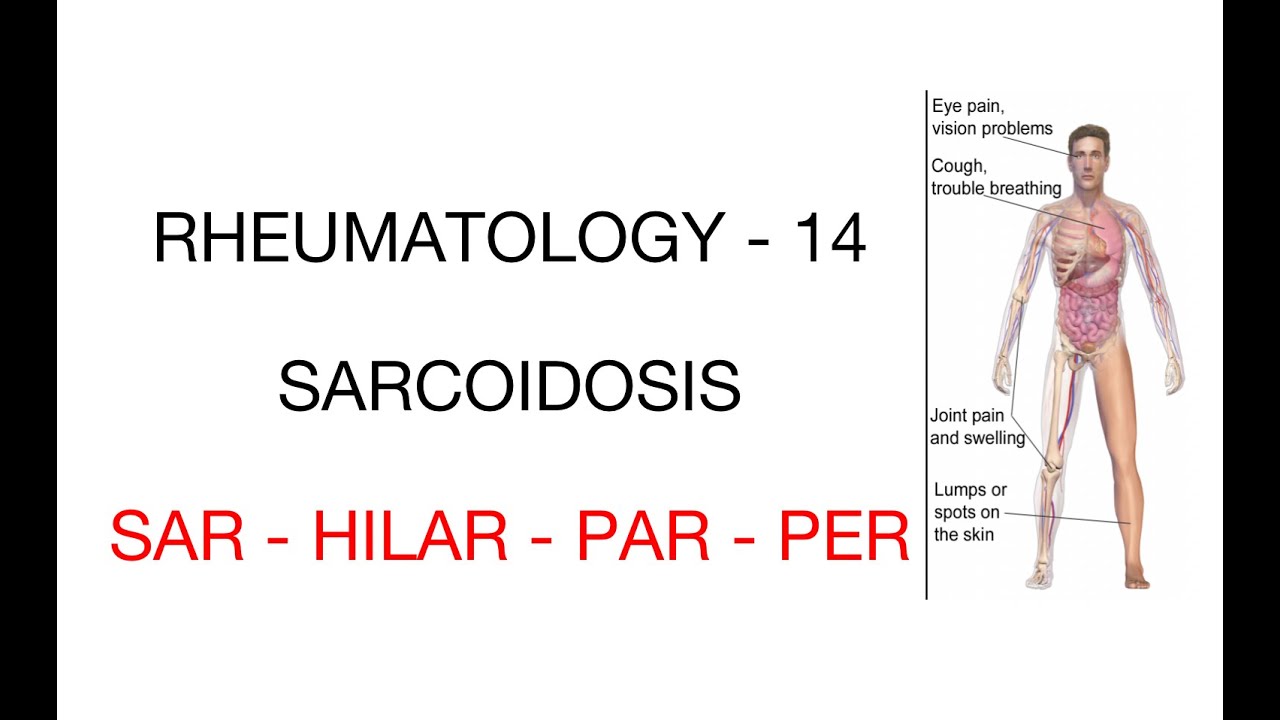 SARCOIDOSIS with mnemonics - PLAB/PLABABLE GEMS/PLABKEYS - PLAB/USMLE ...