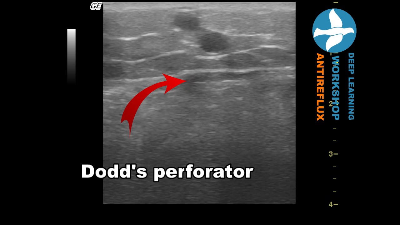 Dodd's perforator - YouTube