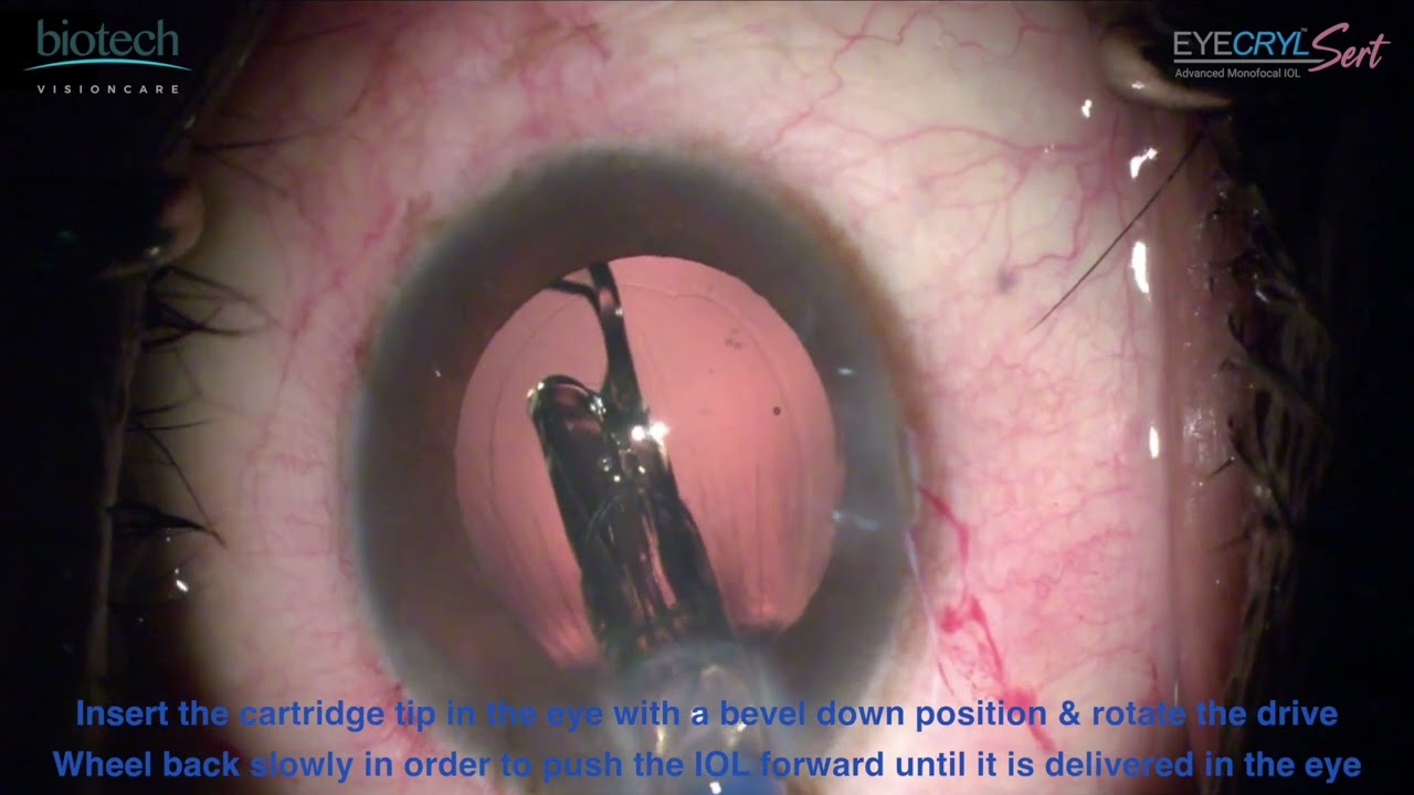 Eyecryl SERT PLHFD6 | Surgery video with explanation. - YouTube