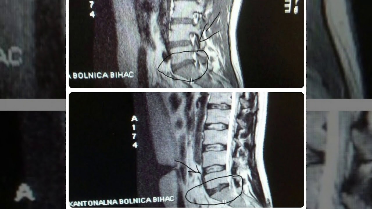 Liječenje DISKUS HERNIJE BEZ OPERACIJE Neoperativno rešenje je ...
