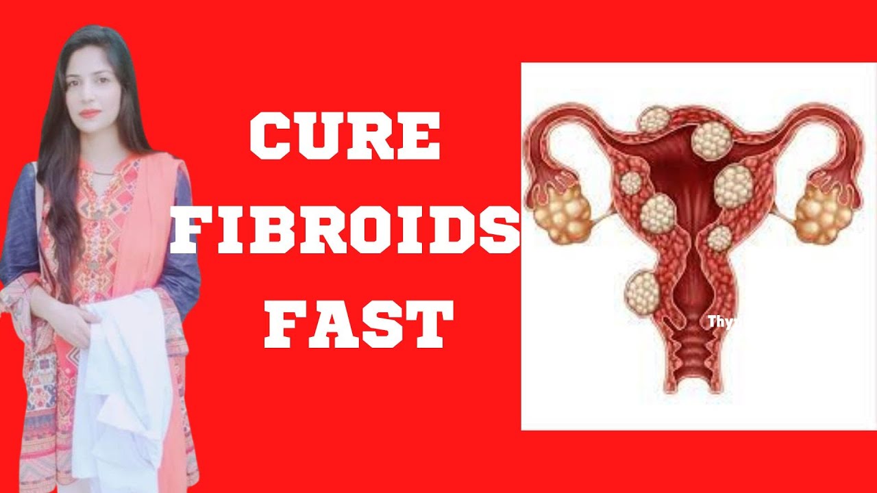 fibroid and endometriosis explained/how are uterine fibroid treated ...