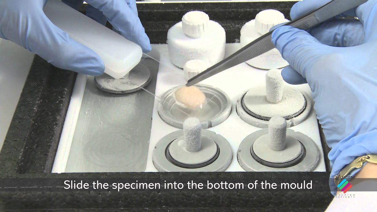 BOP-108 How to freeze skin for MOHS surgery - YouTube