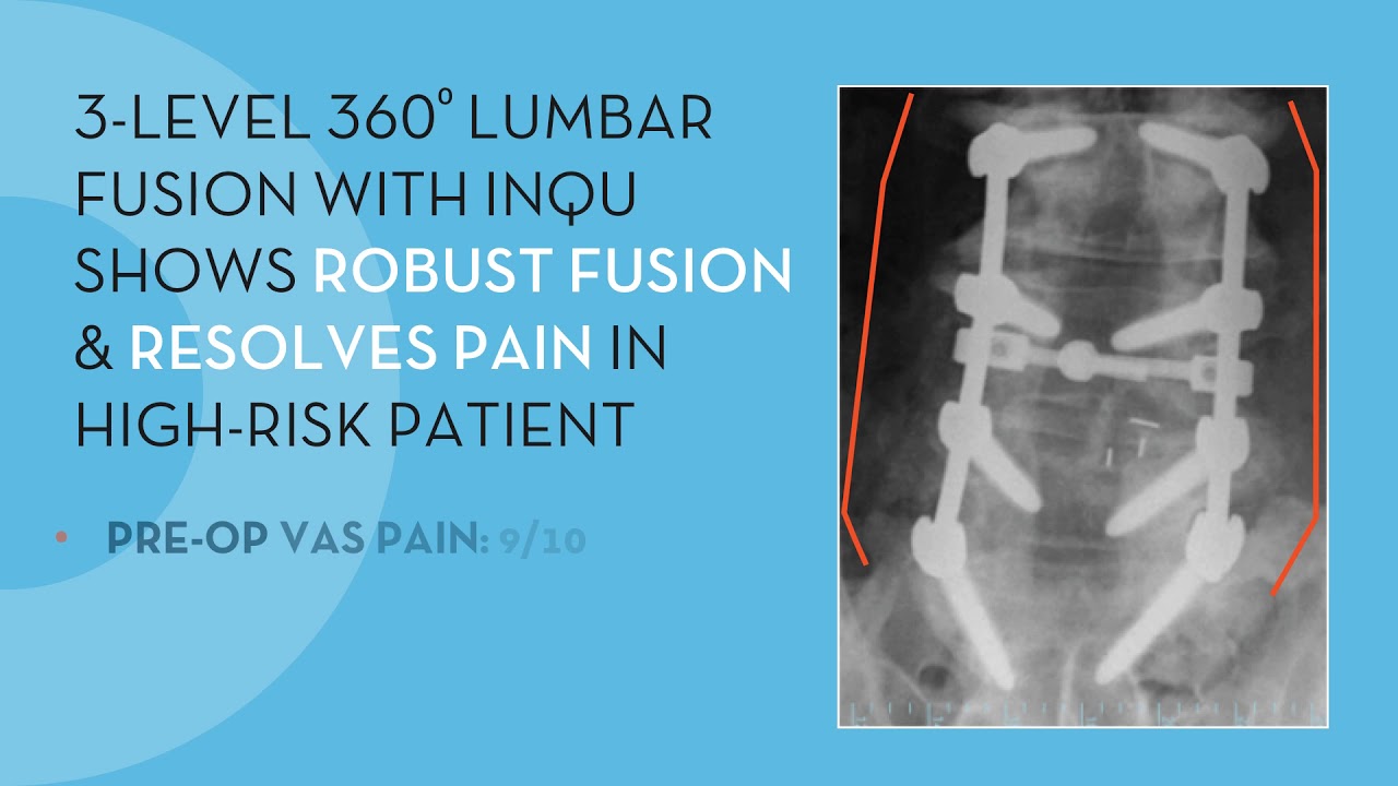 InQu® Bone Graft Extender and Substitute - YouTube