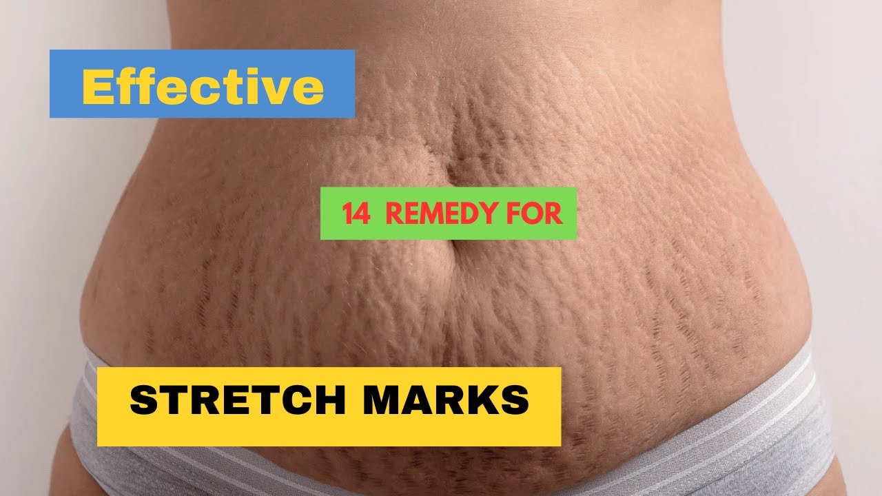 14 REMEDIES FOR WOMEN STRETCH MARKS - YouTube