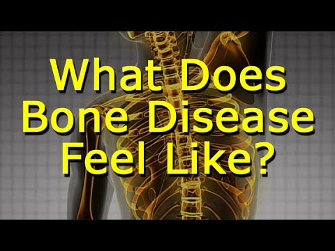 What Does Bone Disease Feel Like? - YouTube