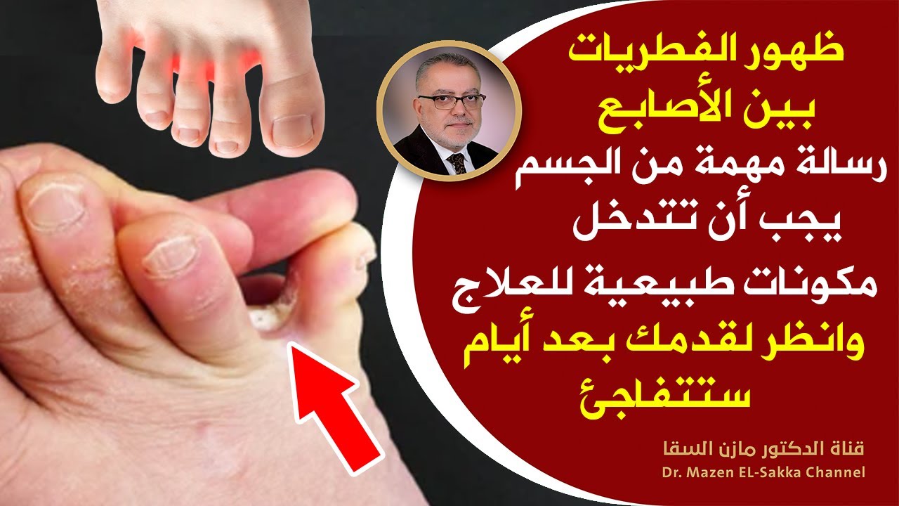 أعظم علاج لفطريات القدمين والفطريات الجلدية تآكل بين الأصابع ورائحة