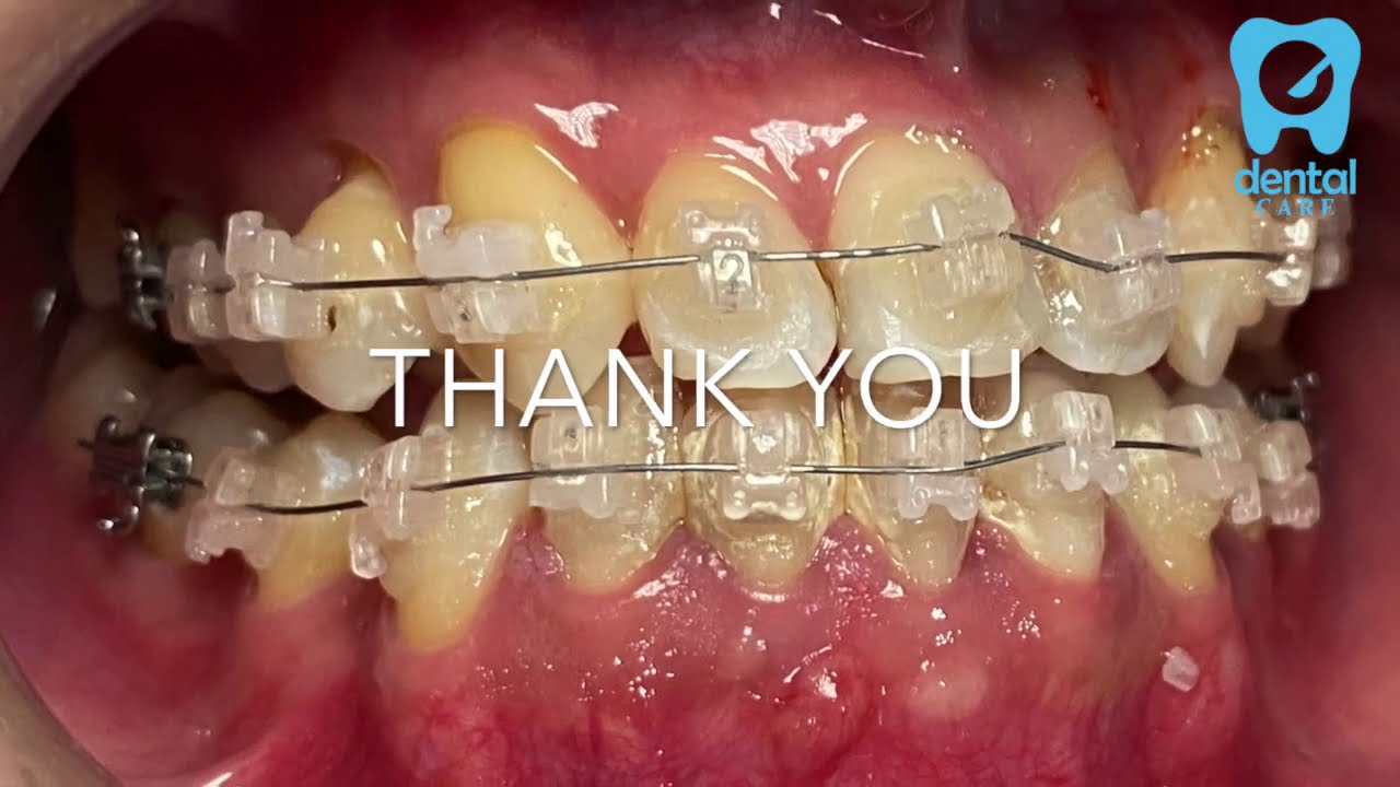 Kontrol Behel SELF LIGATING! - YouTube