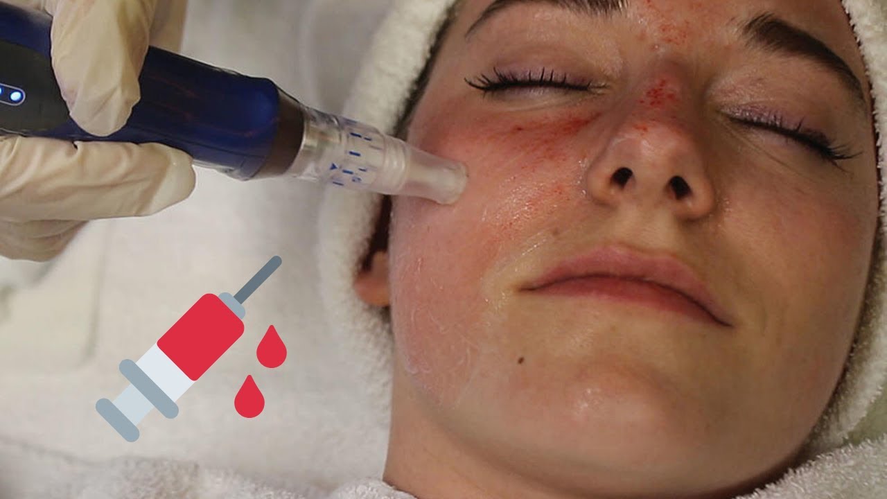 Getting 15 Needs Poked in My Face + Microneedling + Review - YouTube