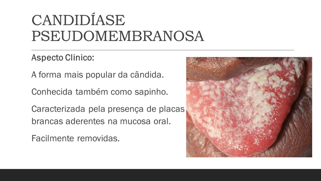 CANDIDÍASE PSEUDOMEMBRANOSA - PROJETO INTEGRADOR - YouTube
